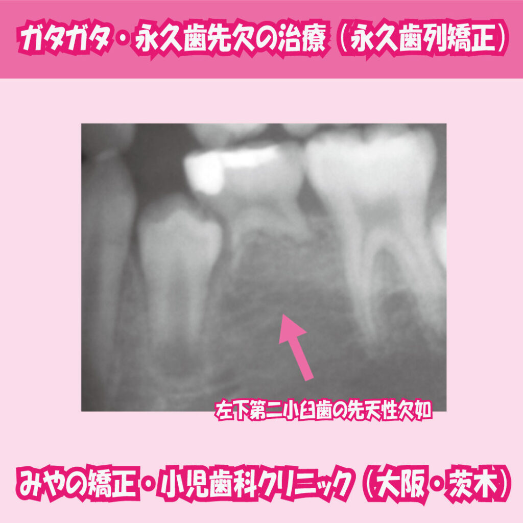 ガタガタ・永久歯先欠の治療永久歯列矯正 矯正症例集 みやの矯正・小児歯科クリニック