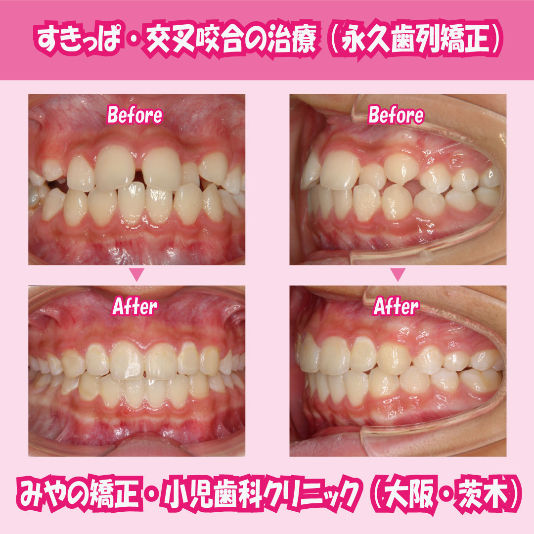 すきっぱ・交叉咬合の矯正治療永久歯列矯正 矯正症例集 みやの矯正・小児歯科クリニック